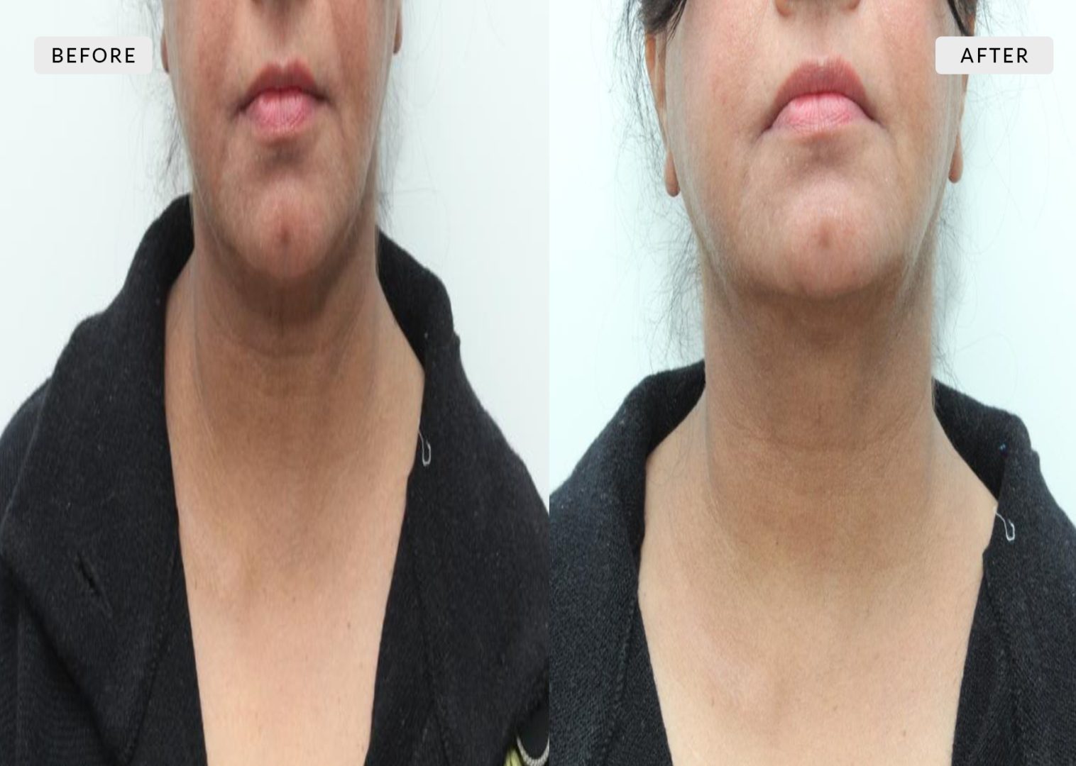 What is a Non-Surgical Neck Lift in South Delhi?